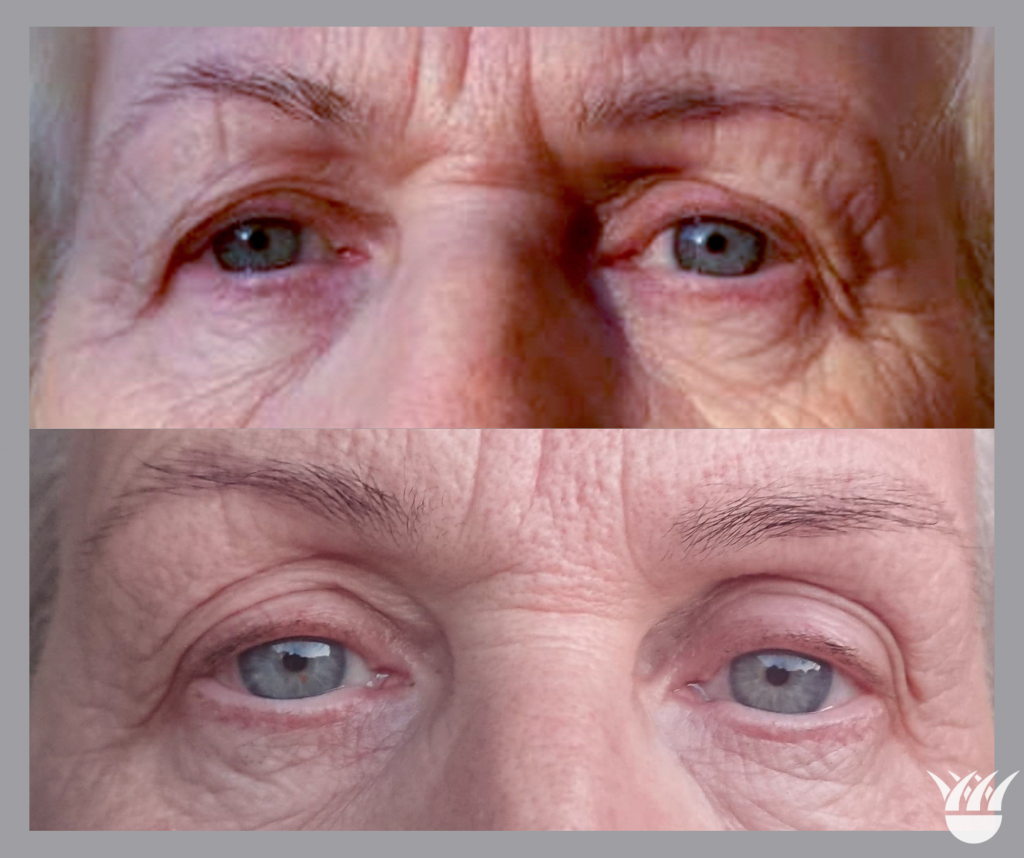 PLEXR® Plasma Soft Surgery - Roosmarii Kliinik