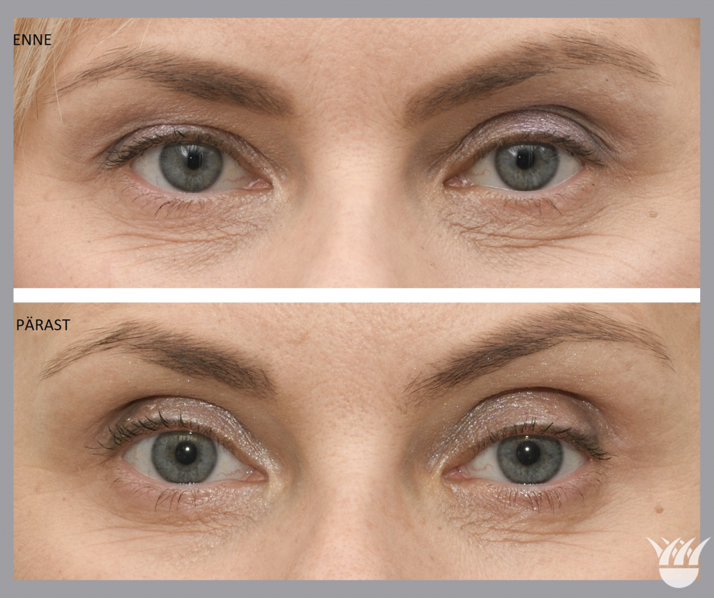 PLEXR® Plasma Soft Surgery - Roosmarii Kliinik